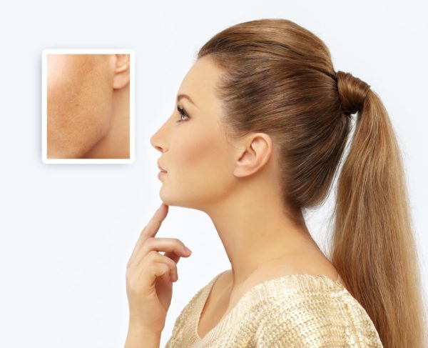 Hyperpigmentation - What Is It And Why Does It Occur?