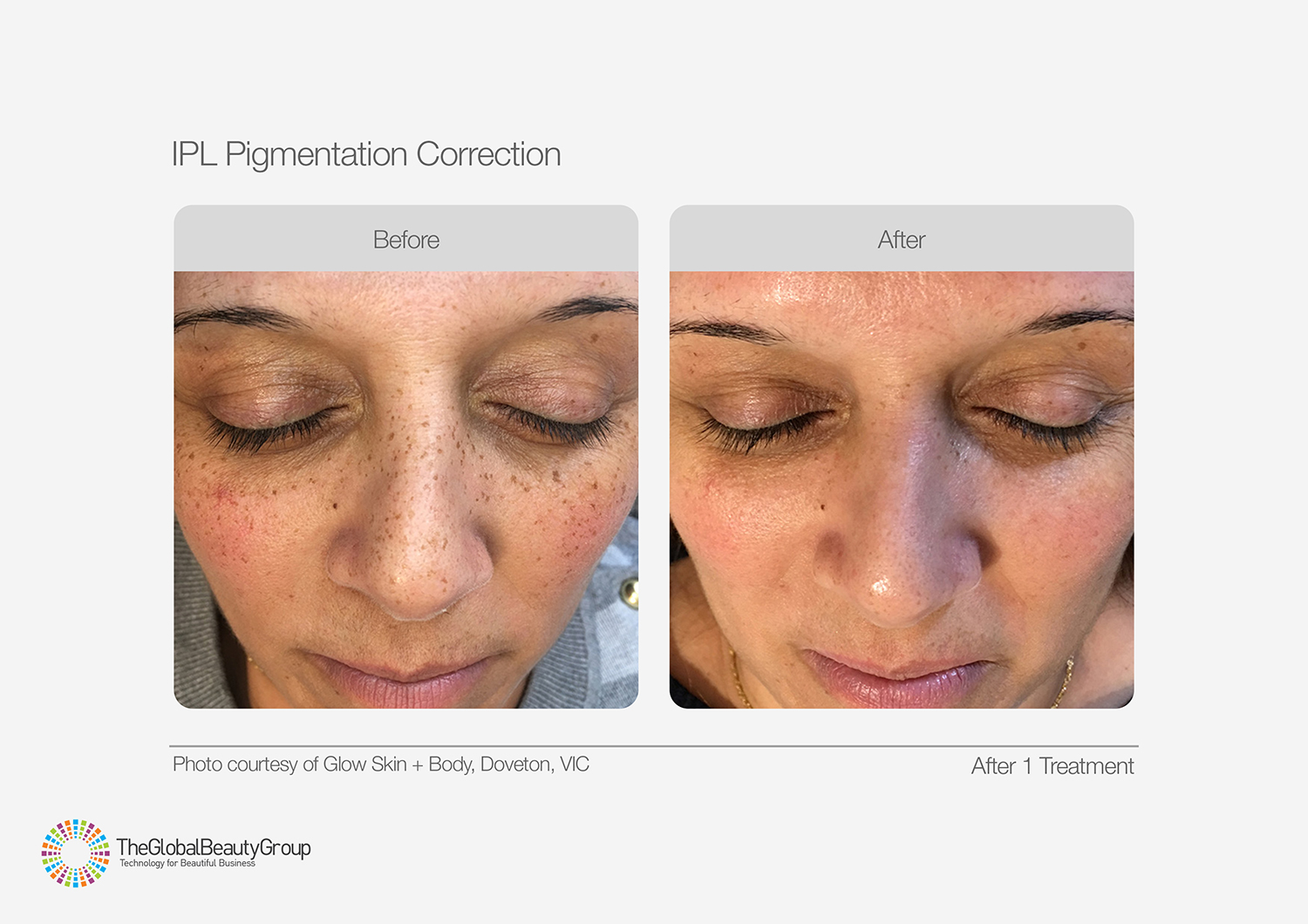 IPL For Skin Hyperpigmentation: A Path To Clearer Skin | Luxe ...